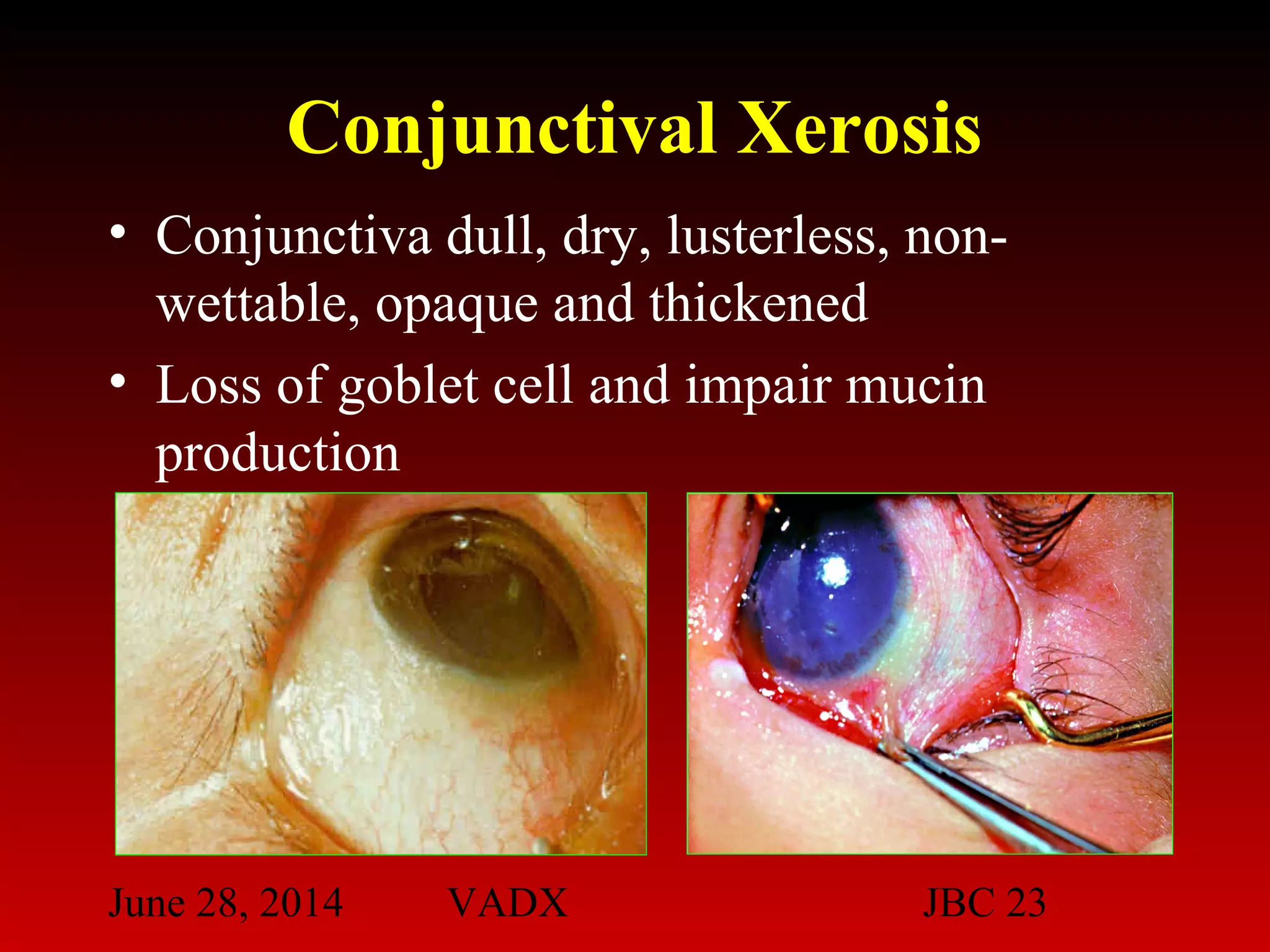 Xerophthalmia | PPT
