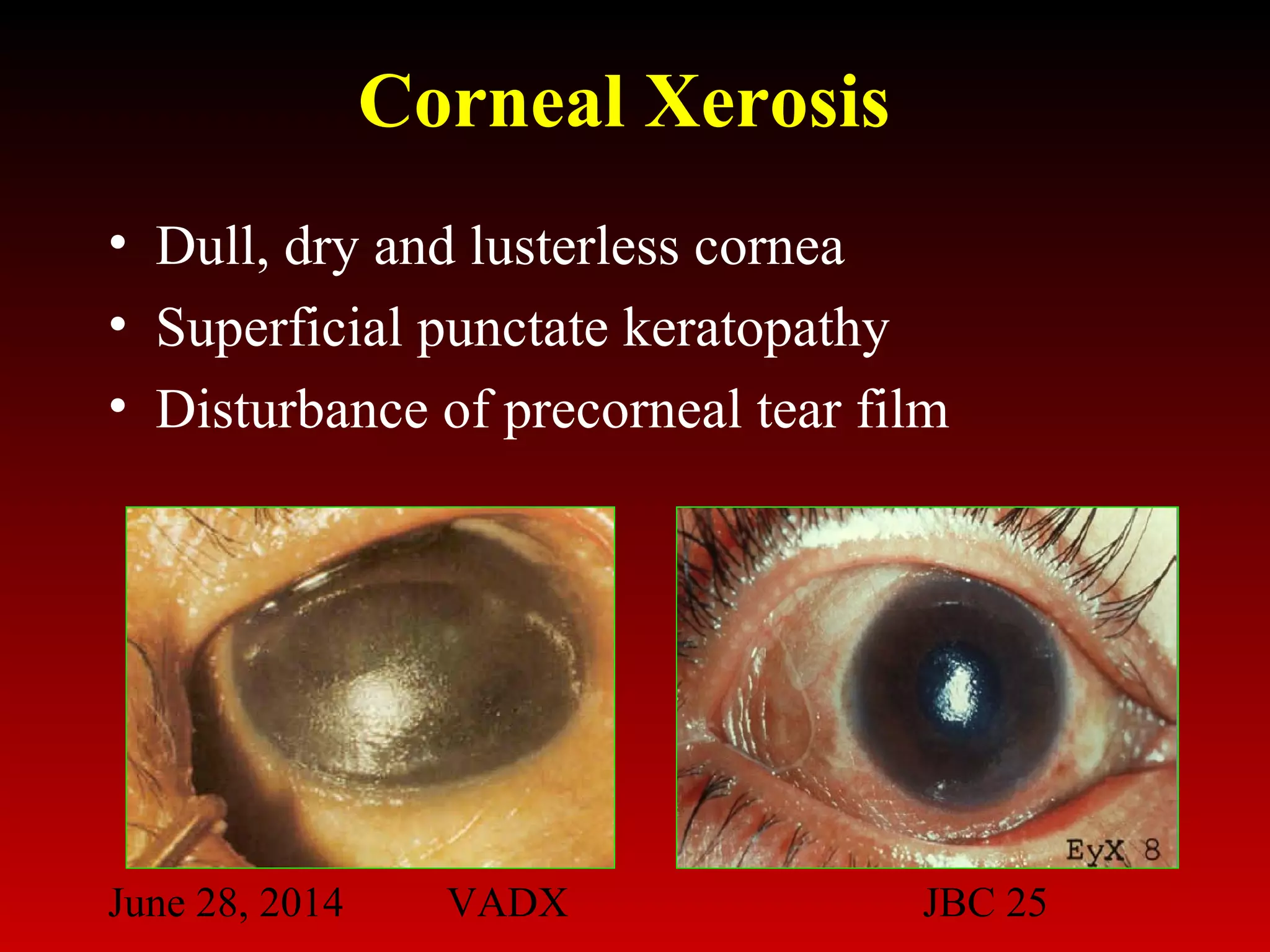 Xerophthalmia | PPT