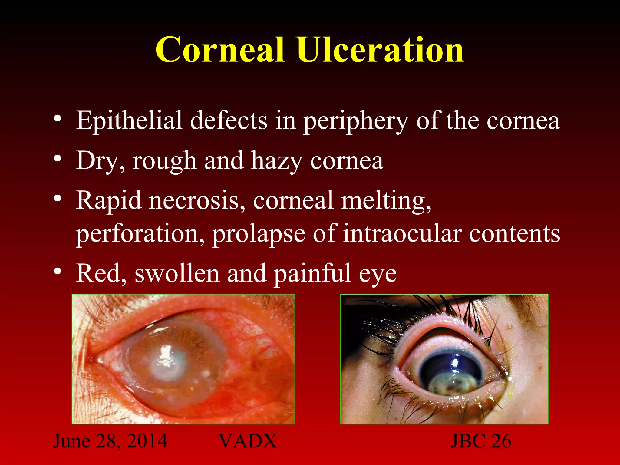 Xerophthalmia | PPT