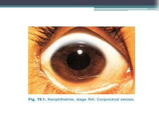 Xerophthalmia | PPTX