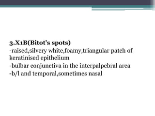 Xerophthalmia | PPTX