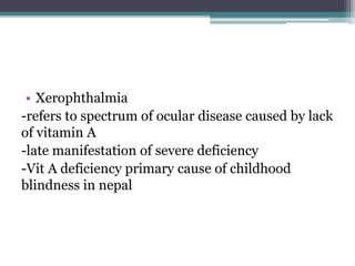Xerophthalmia | PPTX