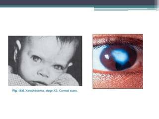 Xerophthalmia | PPTX