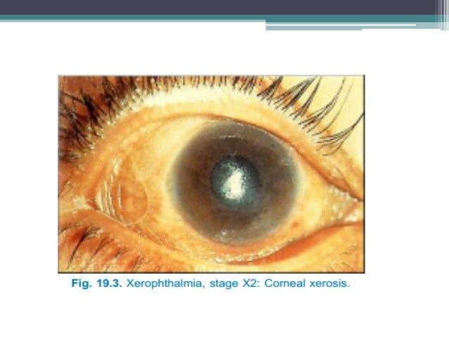 Xerophthalmia