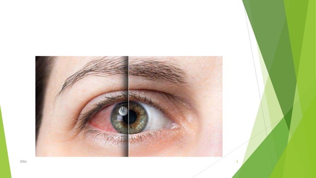 Xerophthalmia.pptx | Eye and Vision Conditions | Diseases and Conditions