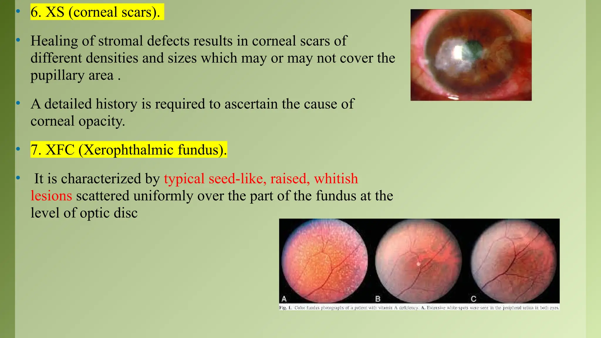 xerophthalmia.pptx, etiology, WHO classification, treatment . | PPTX