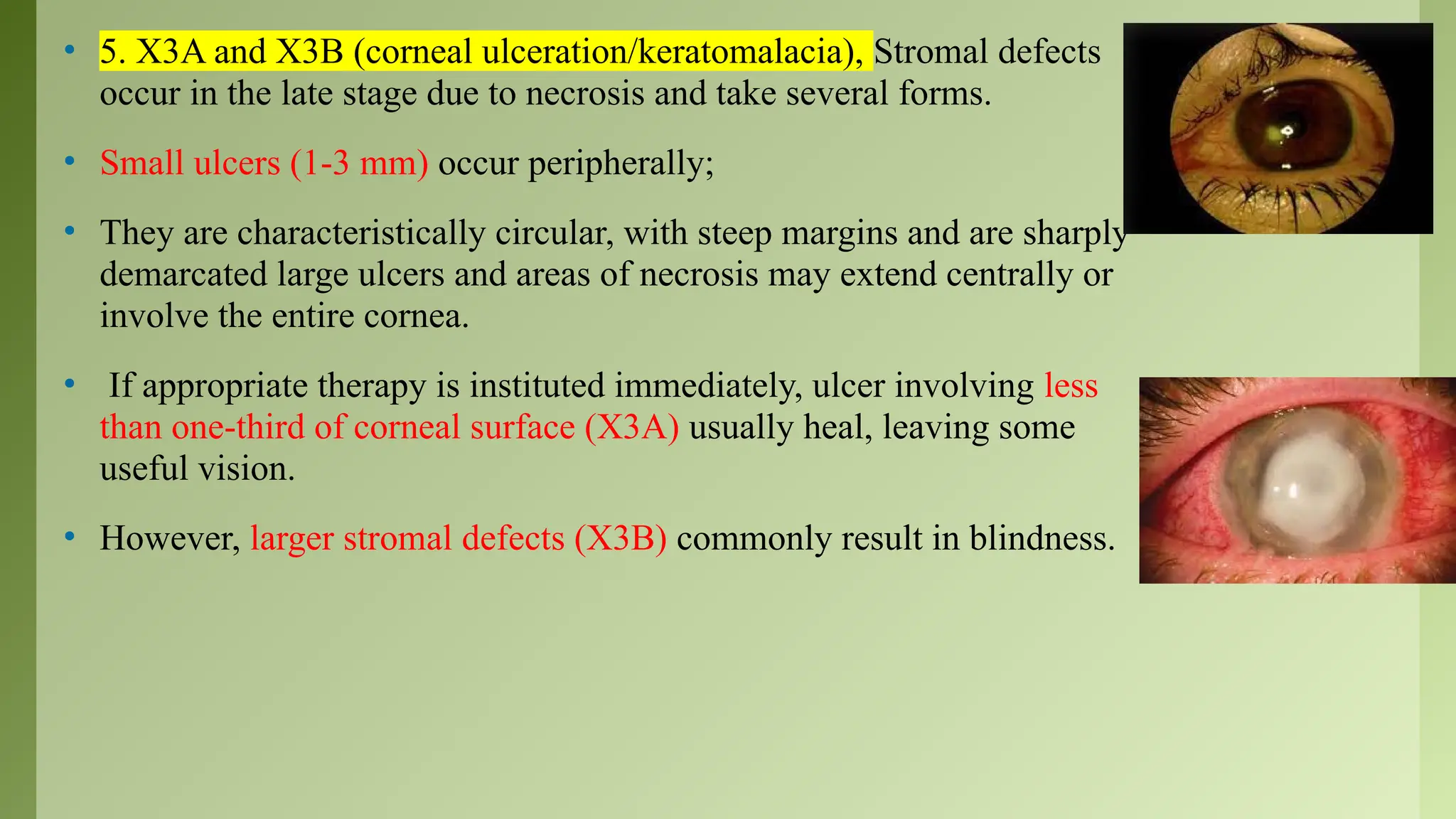xerophthalmia.pptx, etiology, WHO classification, treatment . | PPTX