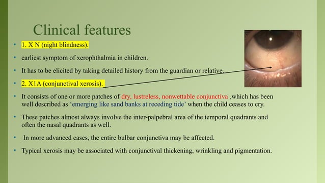 xerophthalmia.pptx, etiology, WHO classification, treatment . | PPTX