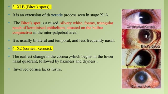 xerophthalmia.pptx, etiology, WHO classification, treatment . | PPTX