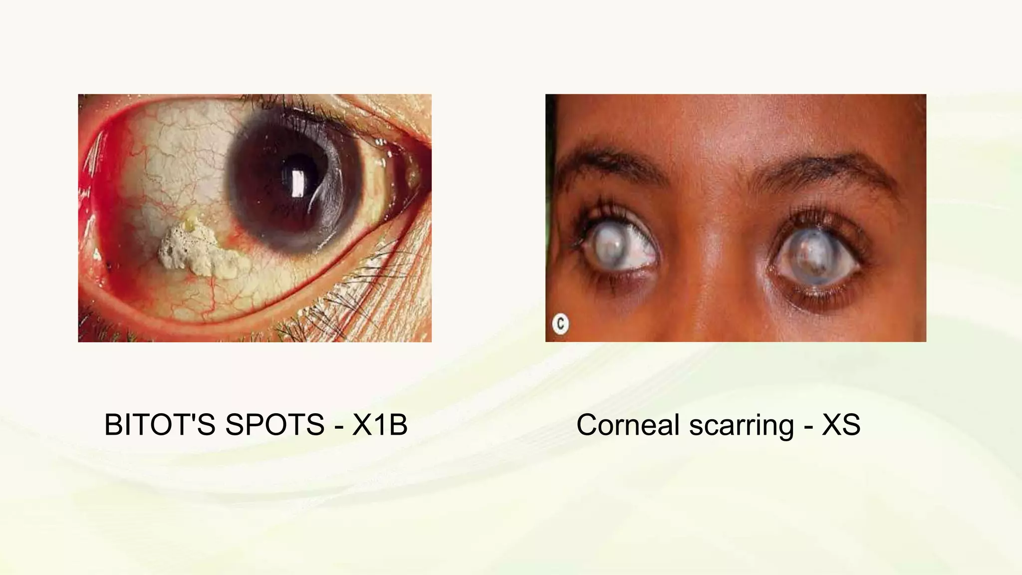 XEROPHTHALMIA --WPS Office.pptx