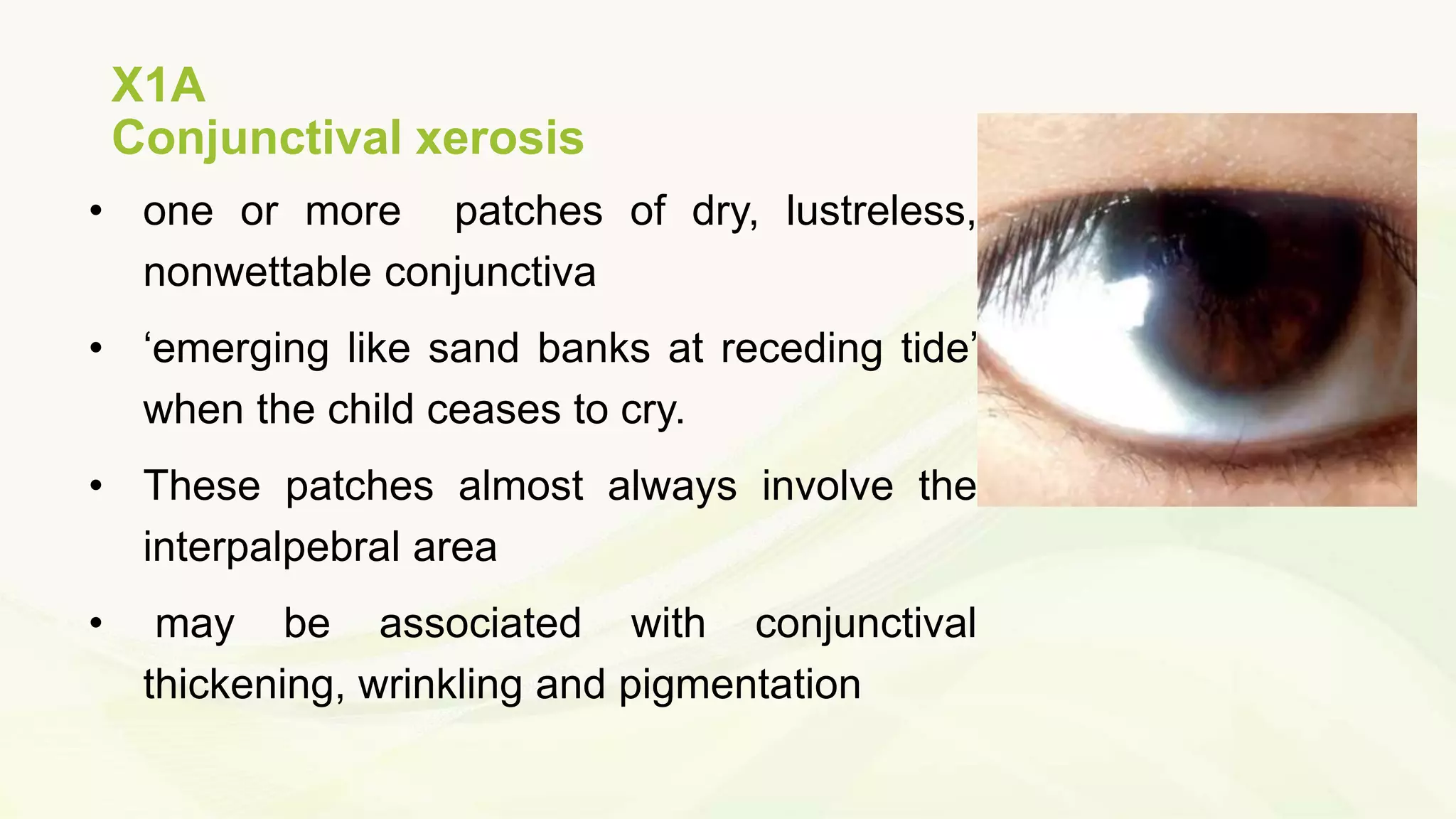 XEROPHTHALMIA --WPS Office.pptx