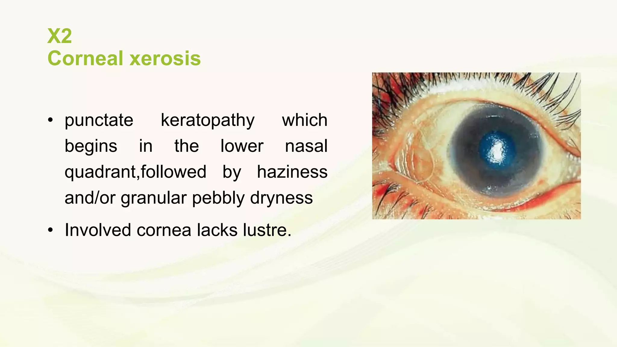 XEROPHTHALMIA --WPS Office.pptx