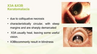 XEROPHTHALMIA --WPS Office.pptx