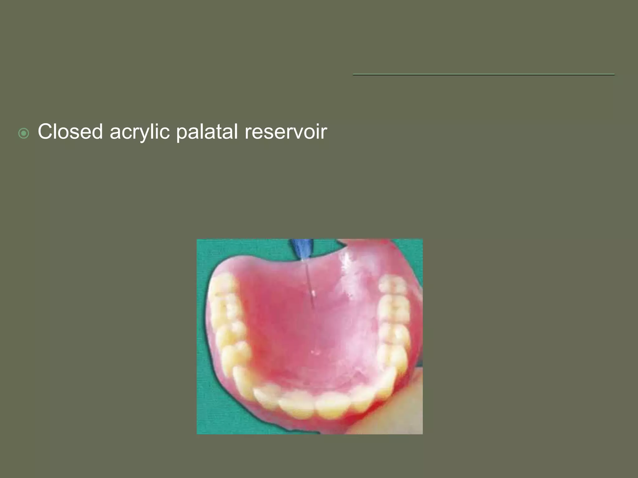 Split denture prosthesis for xerostomia- Journal Club | PPTX