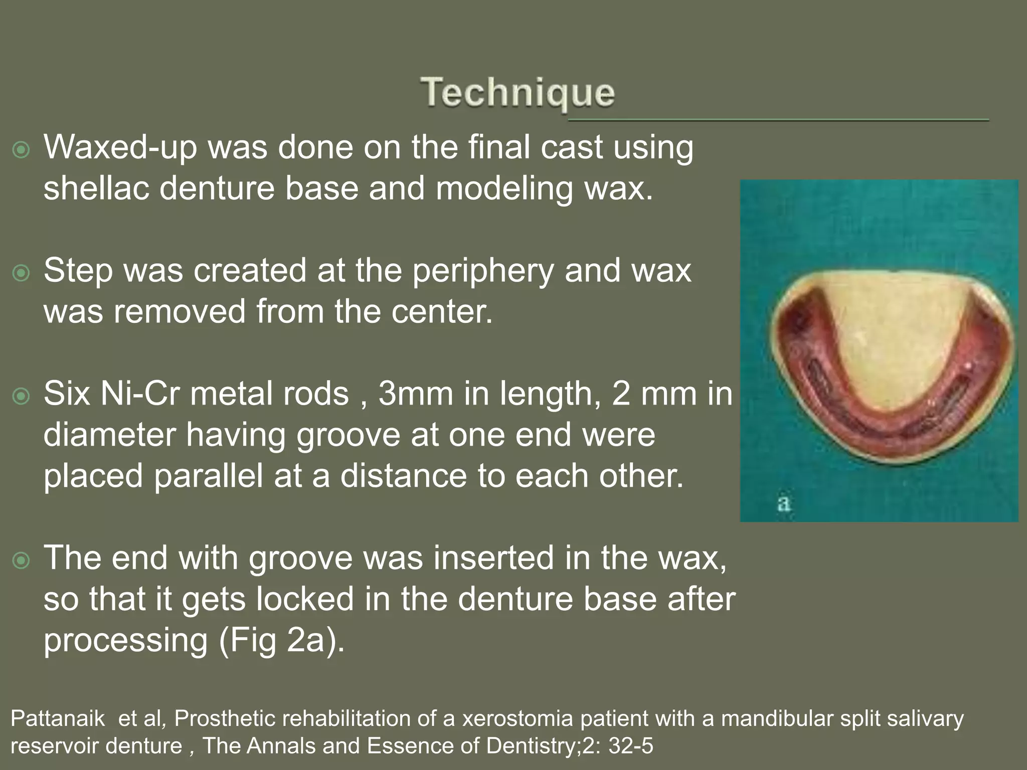 Split denture prosthesis for xerostomia- Journal Club | PPTX