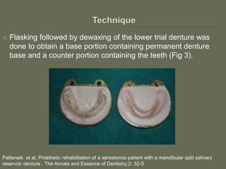 Split denture prosthesis for xerostomia- Journal Club | PPTX
