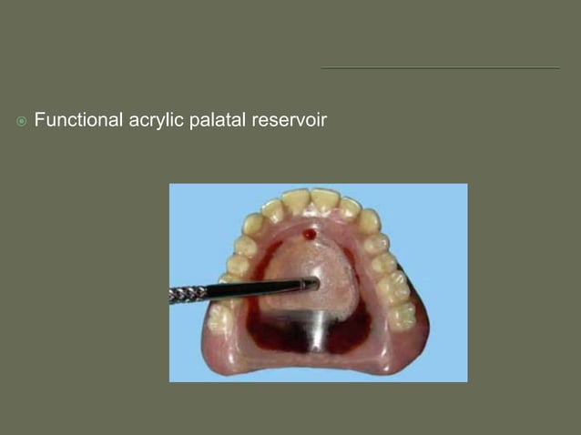 Split denture prosthesis for xerostomia- Journal Club | PPTX