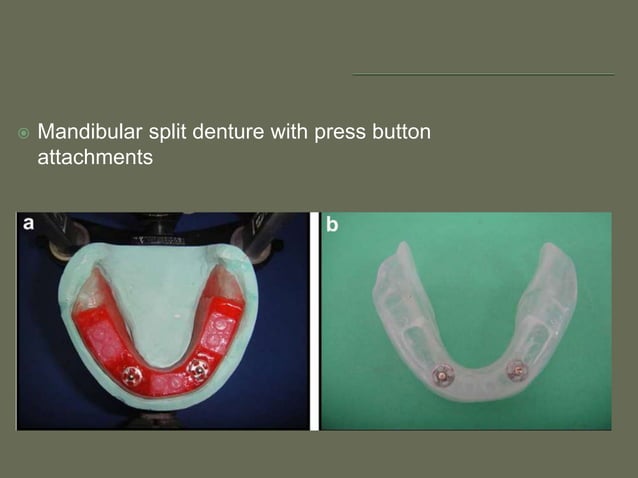 Split denture prosthesis for xerostomia- Journal Club | PPTX