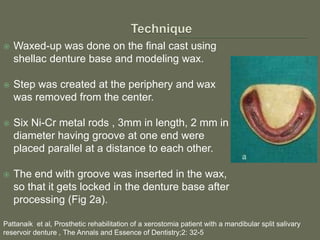 Split denture prosthesis for xerostomia- Journal Club | PPTX