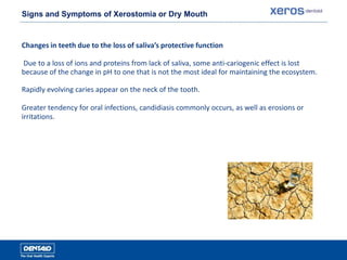 6 things that you should kwow about Xerostomia | PPT