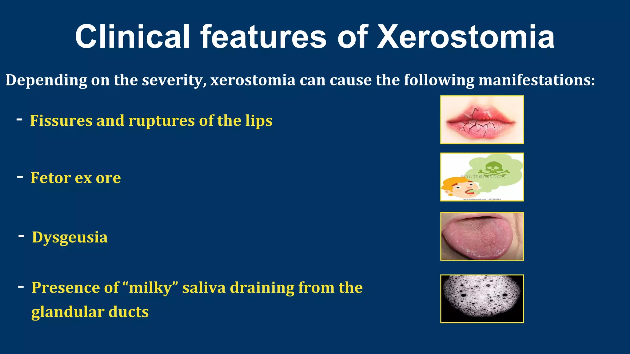 Xerostomia | PPTX