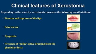 Xerostomia | PPTX