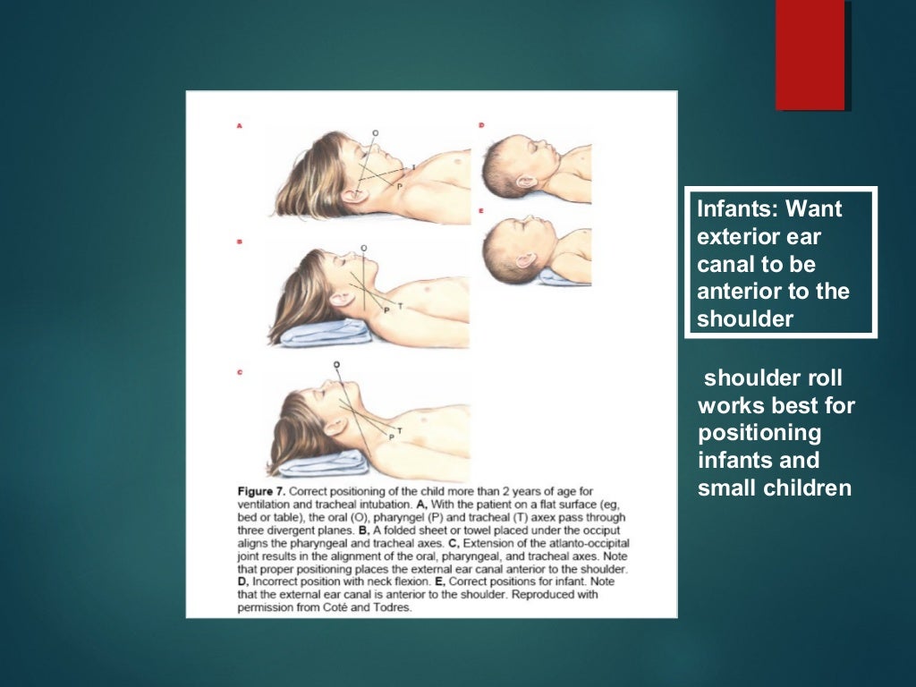 Pediatric airway management