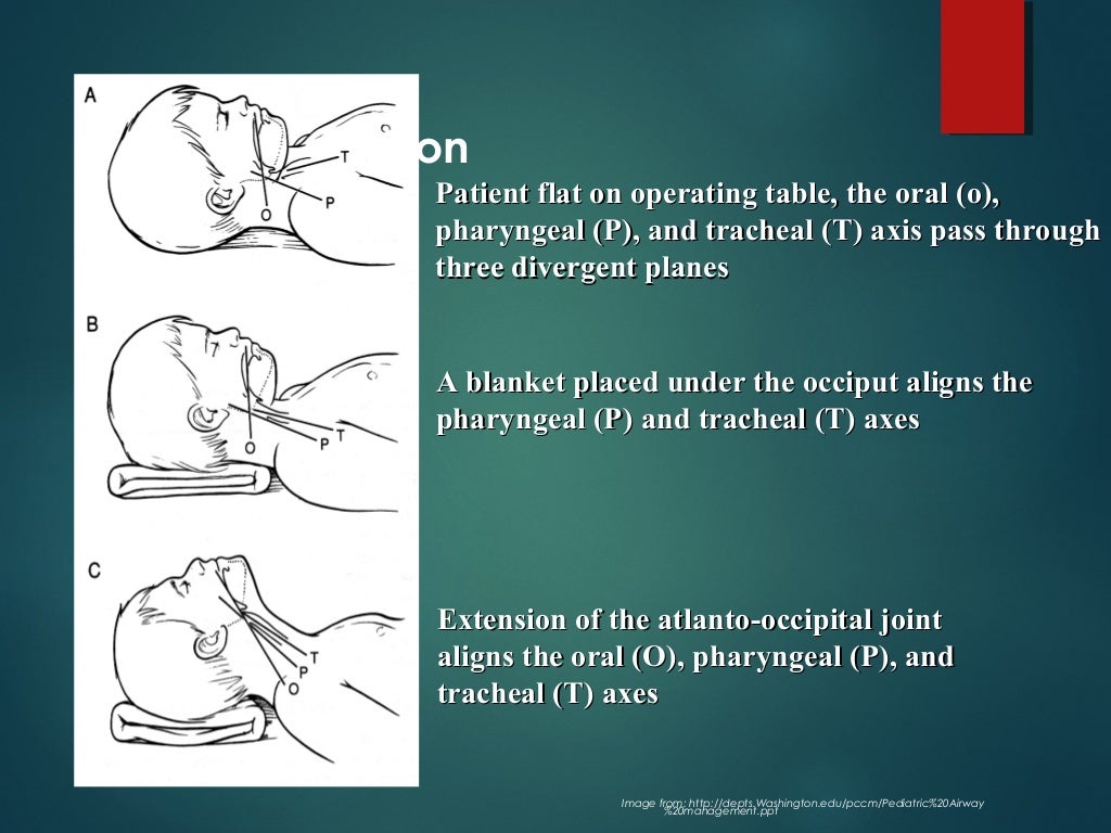 Pediatric airway management