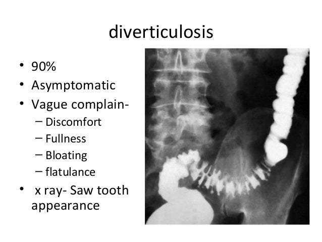Colonic diverticulosis neo