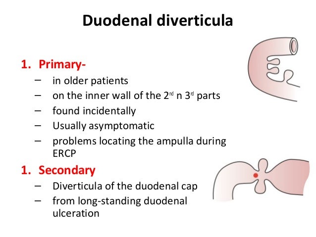 Colonic diverticulosis neo