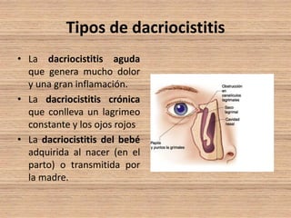 Dacriocistitis Diagn stico Y Tratamiento PPTX