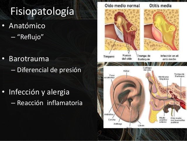 Otitis media aguda