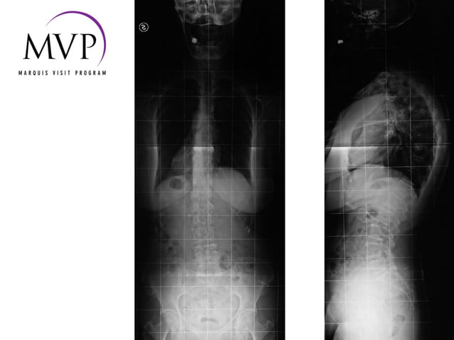 Xlif Case Review | PPT