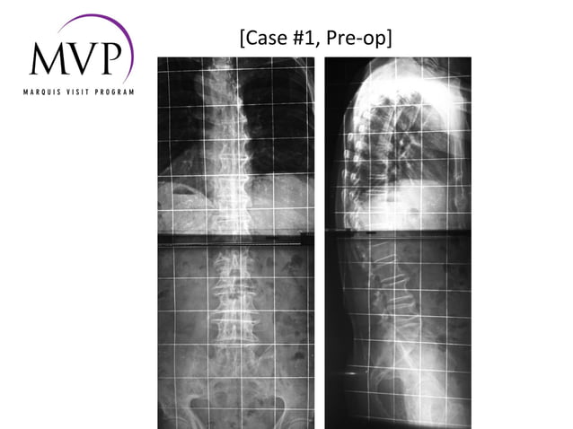 Xlif Case Review | PPT