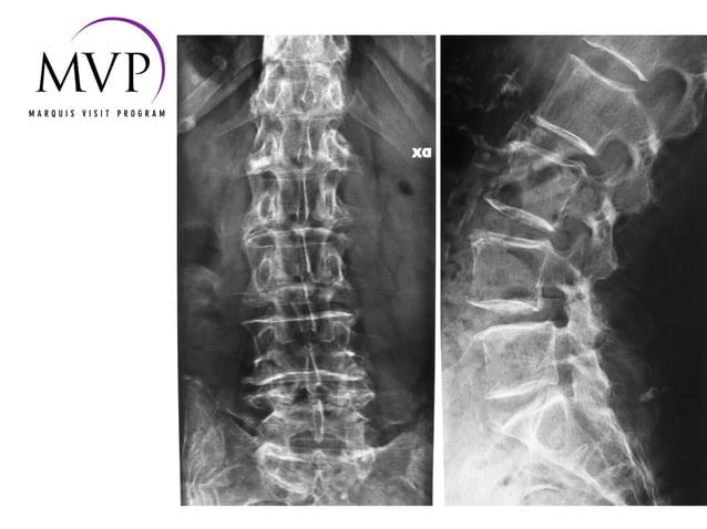 Xlif Case Review | PPT
