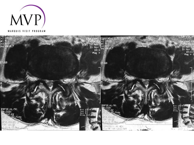 Xlif Case Review | PPT