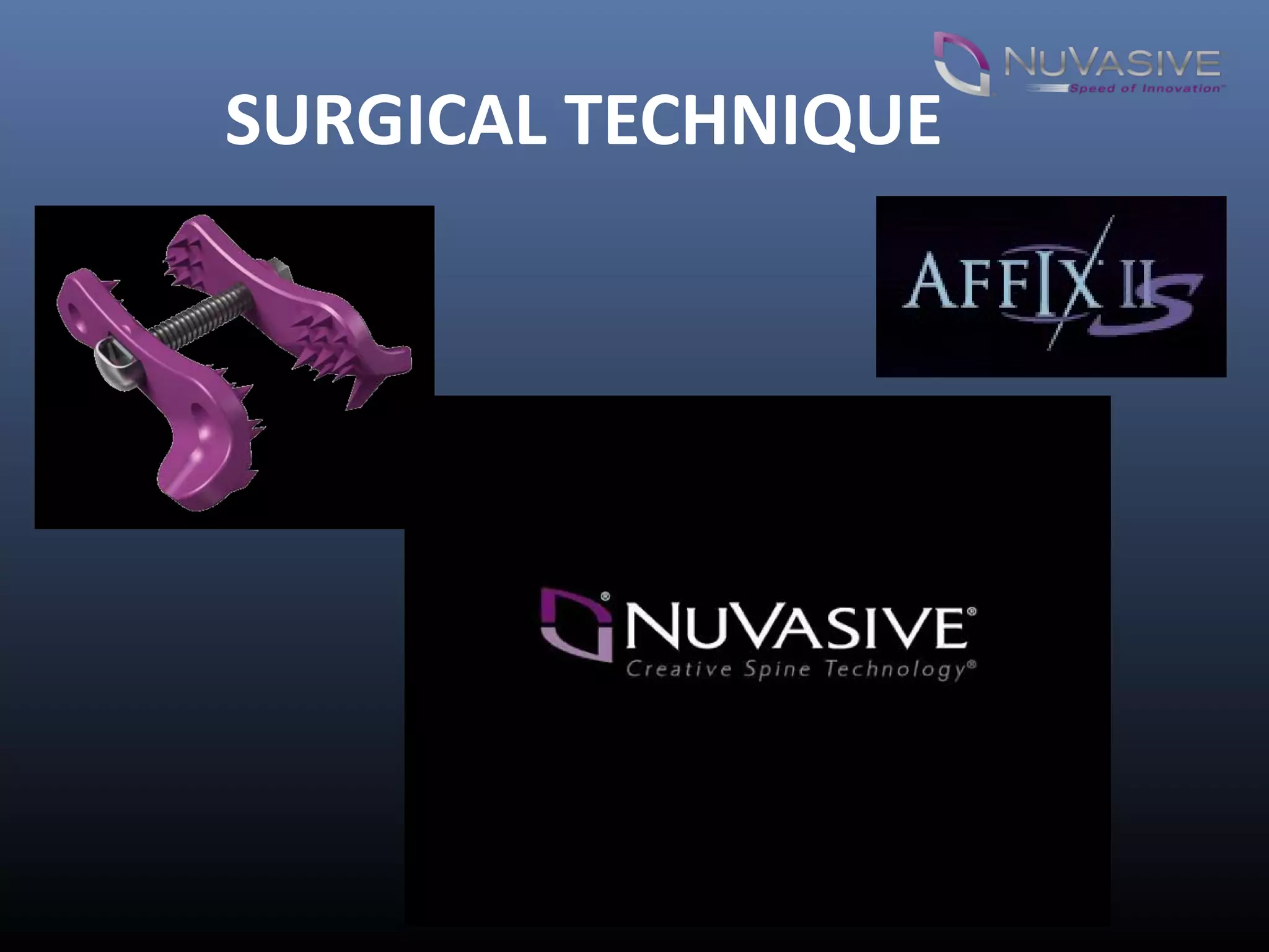 XLIF + ILIF ®circumferential arthrodesis as a minimally invasive | PPT
