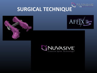 XLIF + ILIF ®circumferential arthrodesis as a minimally invasive | PPT