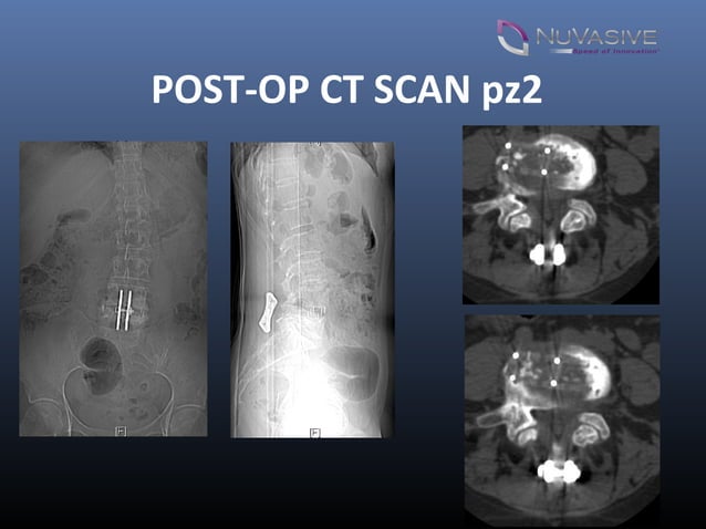 XLIF + ILIF ®circumferential arthrodesis as a minimally invasive | PPT