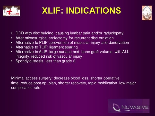 Xlif in the treatment of ddd