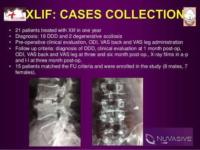 Xlif in the treatment of ddd