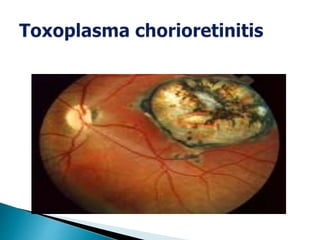 Xori̇oreti̇ni̇t | PPTX