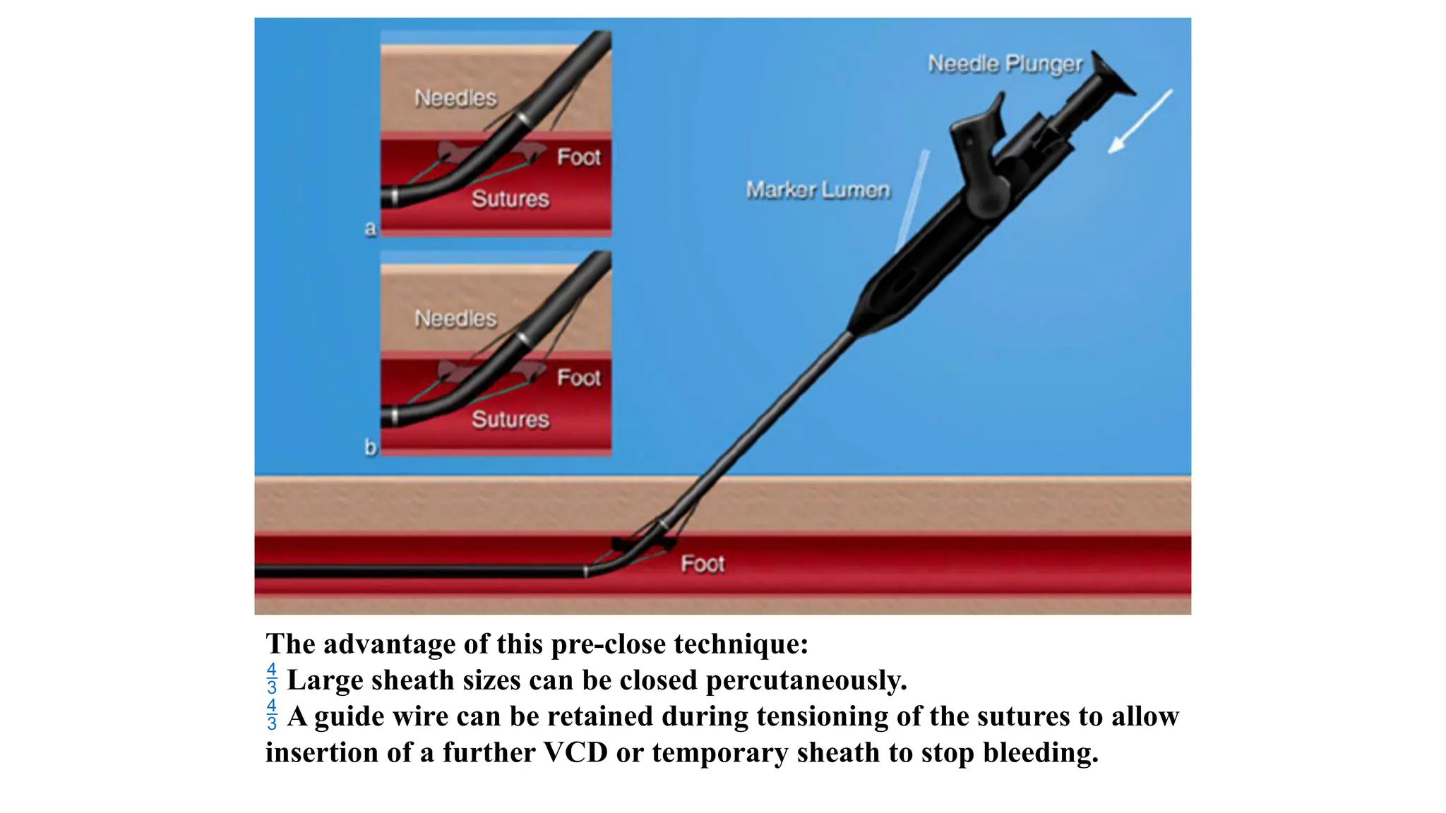 VASCULAR_DEVICE_CLOSURE., cardiologypptx | PPT