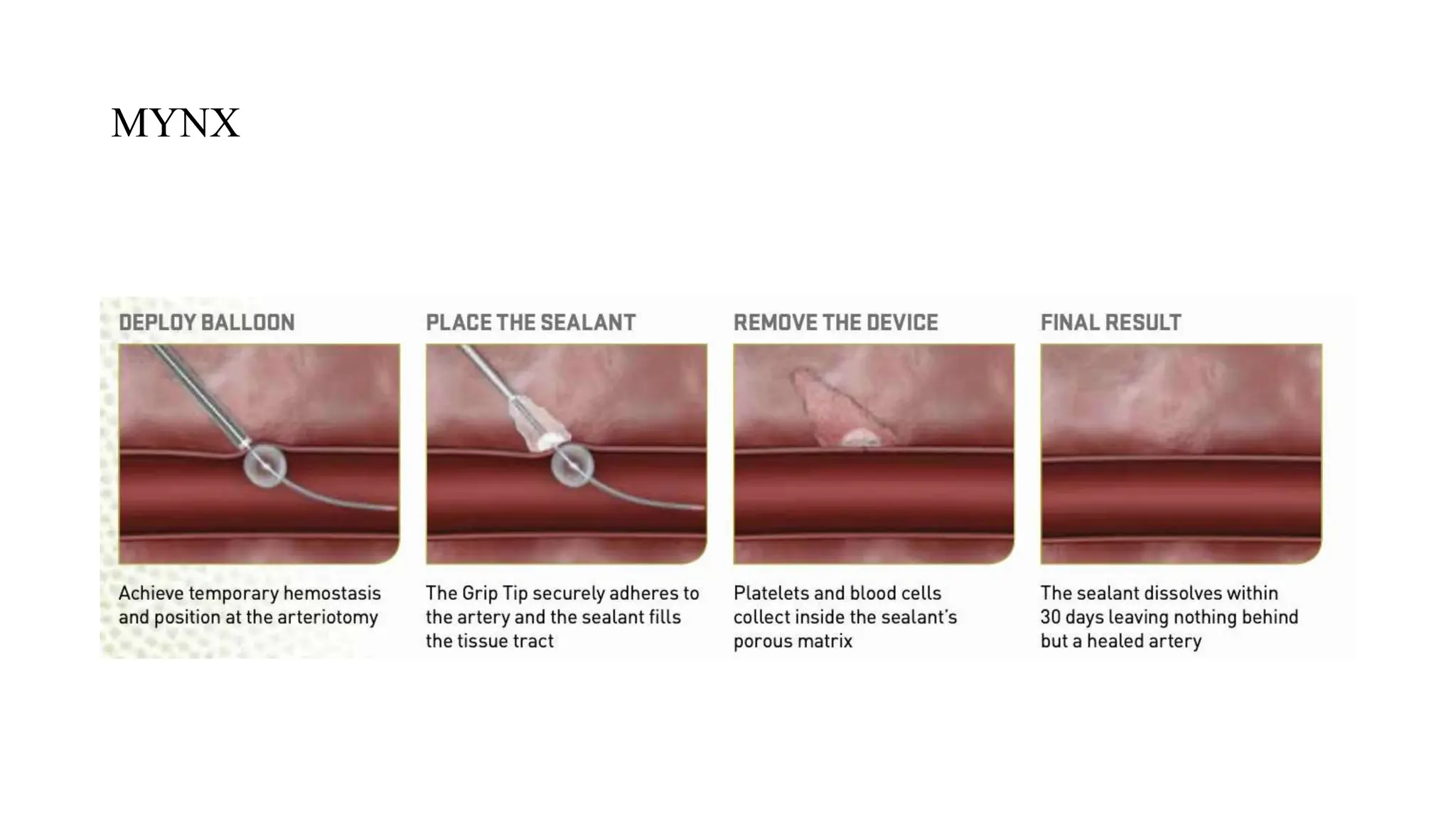 VASCULAR_DEVICE_CLOSURE., cardiologypptx | PPT