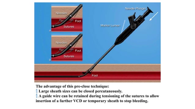 VASCULAR_DEVICE_CLOSURE., cardiologypptx | PPT