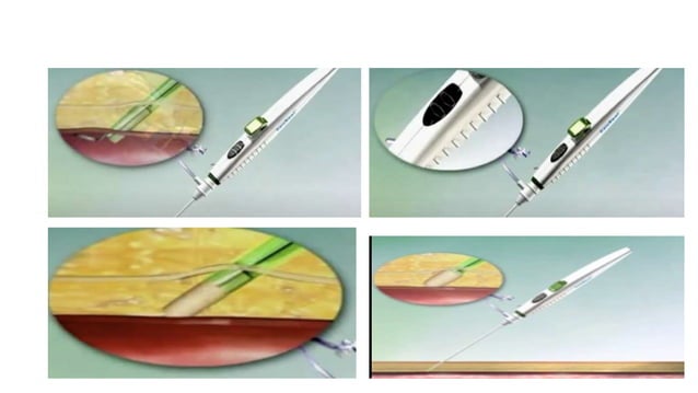 VASCULAR_DEVICE_CLOSURE., cardiologypptx | PPT