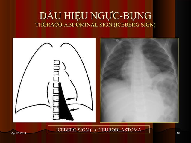 Xquang hội chứng trung thất | PPT