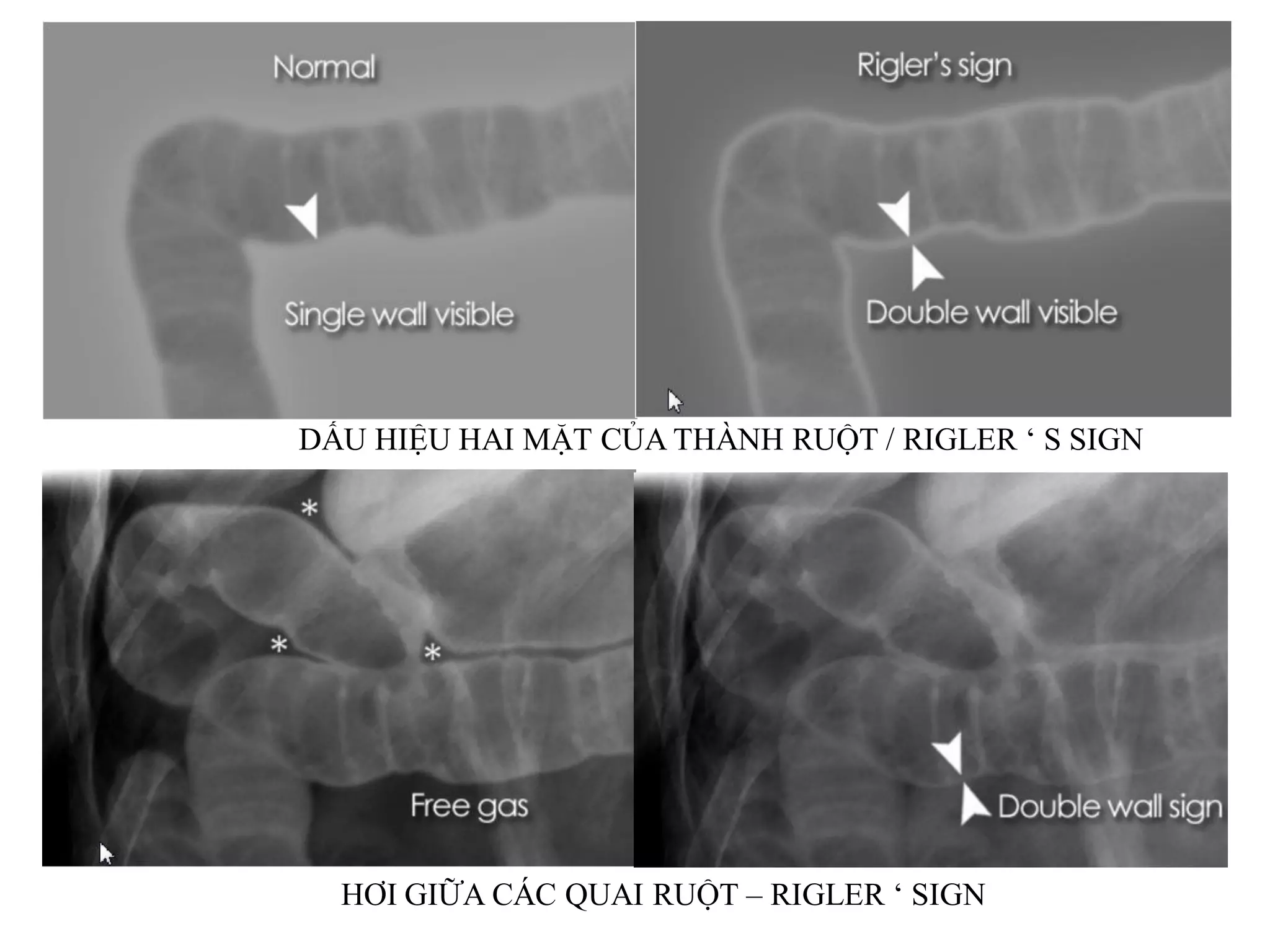 x quang bụng không sửa soạn | PDF