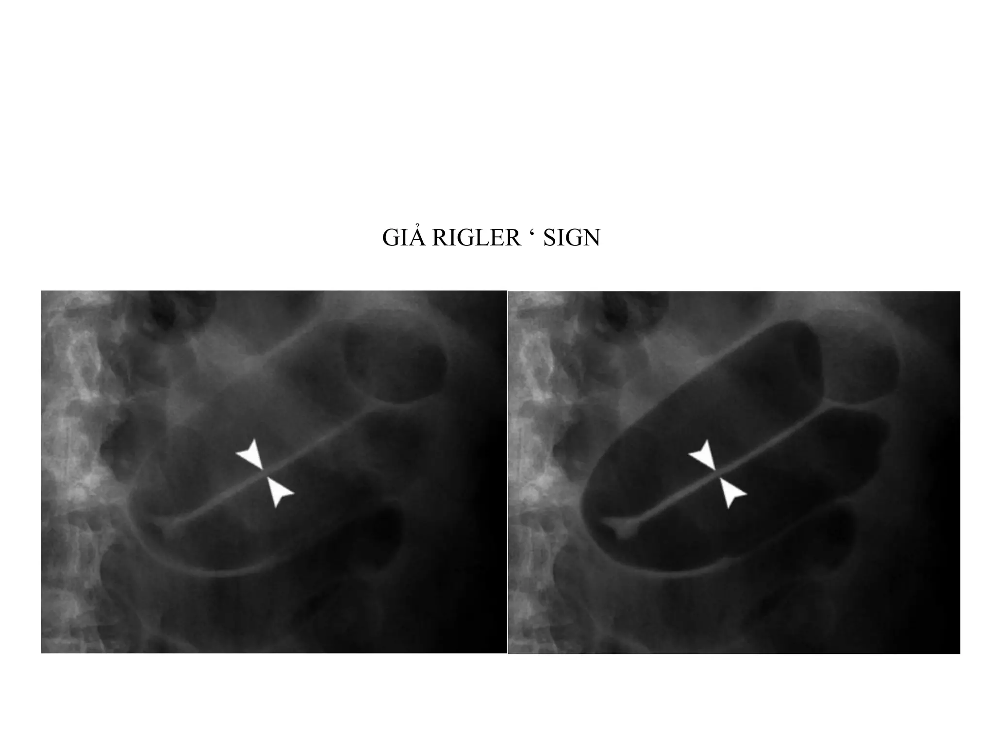 x quang bụng không sửa soạn | PDF