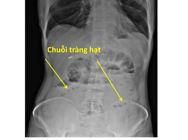 x quang bung khong chuan bi - chuan bi.ppt